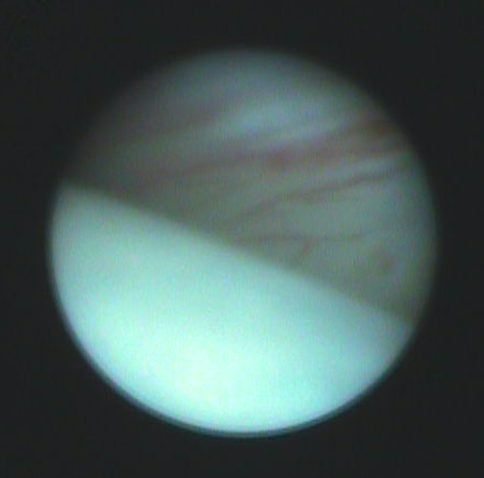 Minimally Invasive TMJ Arthroscopy | Elledge Surgical | Birmingham ...