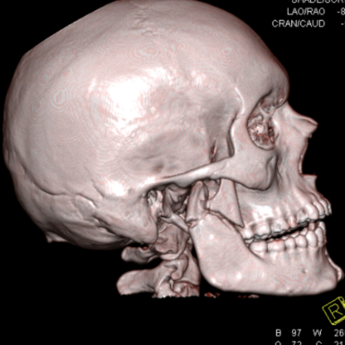 Mandibular fractures - Birmingham, Solihull and Sutton Coldfield Oral and Maxillofacial Surgery ...